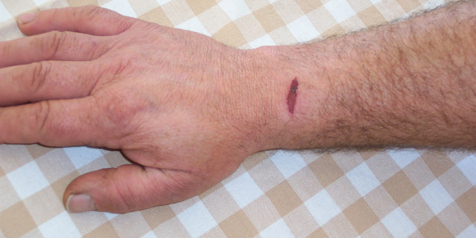 Nuova proteina può accelerare la guarigione delle ferite - Giornale di ...