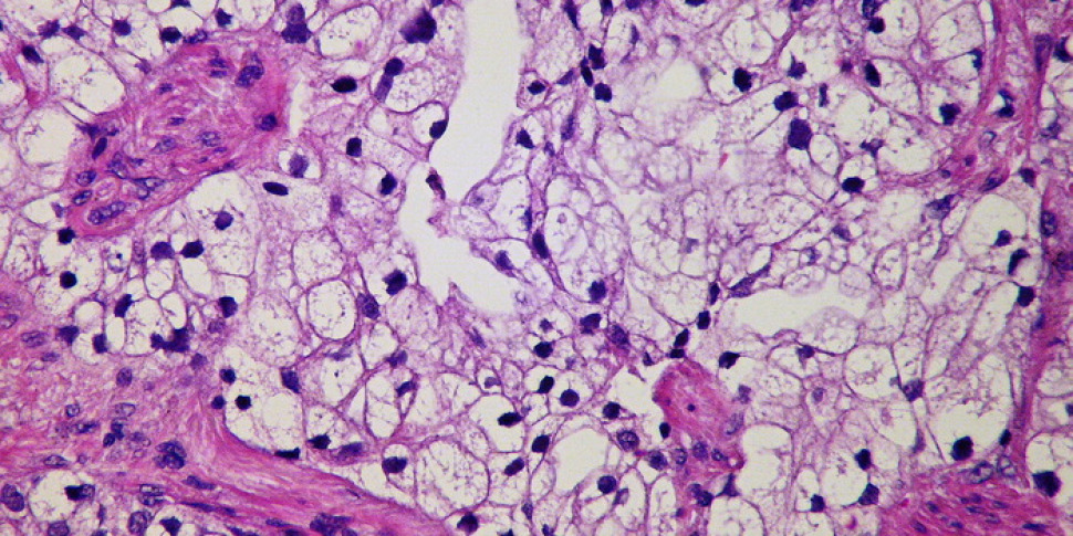 Tumori ai polmoni innescati anche da polveri ultrasottili - Giornale di ...